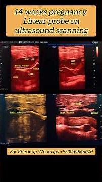 14 weeks pregnancy Linear probe on ultrasound scanning