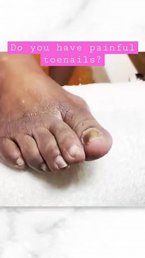 ⭐ ONLINE NAIL EDUCATION CLASSES Nail Technicians 📚 https://pedicuretraining.com https://academy.themeticulousmanicuri... ⭐ Online Training at Home for CAREGIVERS https://pedicuretraining.com/athometr... ⭐ Nail School Partner Program https://www.meticulousmanicurist.com/... ======================== ⭐ WHERE CAN I GET THOSE TOOLS? ➞ https://www.meticulousmanicurist.com/... In today's video, I provide a pedicure tutorial on pincer toenails causing this client pain. She is on her feet all day at her