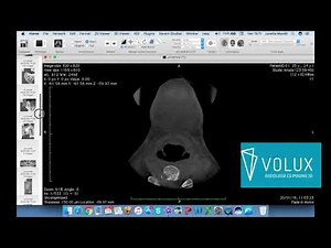 Volux - Tutorial Horos Viewer