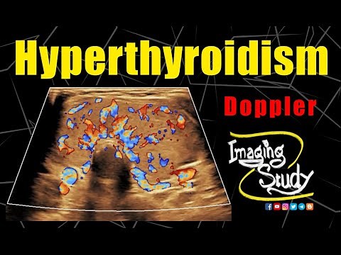Hyperthyroidism | Thyrotoxicosis || Doppler || Ultrasound || Case 294