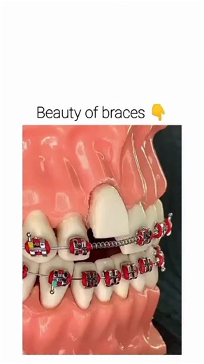 Md Muzmmil Ali on Instagram: "The post features a short video demonstrating UV-induced fluorescence on a dental model fitted with braces, where a disclosing agent applied to the teeth glows green under blacklight to reveal plaque accumulation around the brackets and wires. This technique, termed quantitative light-induced fluorescence (QLF), leverages the physics of light absorption and re-emission by fluorophores in plaque bacteria, enabling non-invasive detection; a 2020 Nature study found QLF