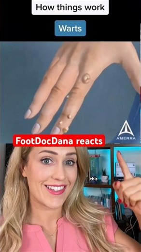 Doctor explains the science of warts