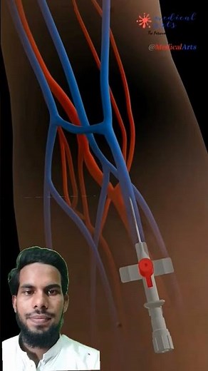 IV Insertion 💉 IntraVenous Catheter ⚕️ 3D Medical Animation Ep.1
