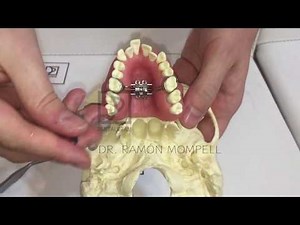 Maxilary Skeletal Expander (MSE), showed by Dr. Ramón Mompell for Dentalgram.