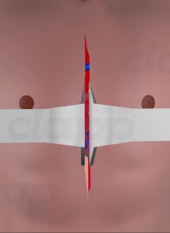 Open heart Bypass Surgery (3D Animation)