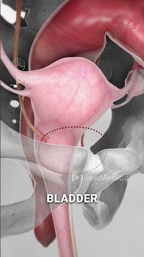 Bladder Removal (3D Animation)