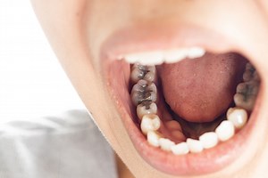 New Study Exposes Significant Health Risks of Mercury Dental Fillings in Pregnant Women