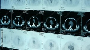 doctor study human orage & bone pet-ct scan,X-ray,Cancer metastasis.