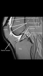 #MRI #knee #lesions #anatomy | CT Scan and MRI study