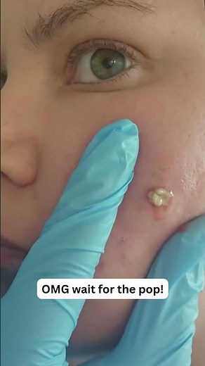 Large Blackheads Extraction Big Cystic Acne Blackheads&Whiteheads Removal Pimple Popping #1023 2026