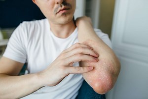What Type of Psoriasis Do You Have?