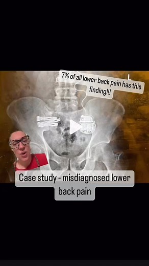 Sunday case study - misdiagnosed lower back pain! 38yo female presents with persistent lower back pain after multiple failed surgeries! What is the reason for her pain? I’ll go through everything tomorrow! #lowbackpain #neurosurgery #casestudy #sundaycasestudy #ladyspinedoc #Spinesurgery #backpain #failedbacksyndrome #spinalcordstimulator #healthcareworker #hospital #surgery #neurosurgeon #medicalschool #medstudent #medicalstudent #nursing #pastudent #paschool #nursingschool #learnonreels | Dr. 