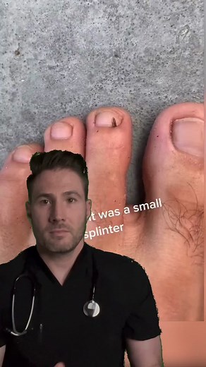 Insanely large splinter removal. #splinterremoval #cystpopping #splinter #foreignbody #erdoctor