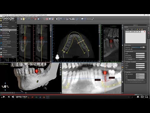 Introduction to Guided Surgery (Everything Blue Sky Plan - Part 1)
