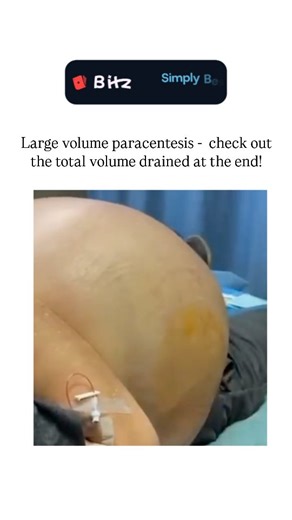 street_decode on Instagram: "The post features a video of large-volume paracentesis, a procedure inserting a catheter to drain ascites—excess abdominal fluid often caused by liver cirrhosis, heart failure, or cancer—revealing approximately 17 litres removed from a patient. Medical guidelines, such as those from the American Association for the Study of Liver Diseases, define large-volume paracentesis as over 5 litres and recommend albumin infusion to prevent circulatory dysfunction, with one stu