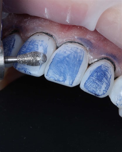 You can only learn so much from watching. The real growth happens when you start doing. 👉🏼 That’s the idea behind HALŌ Live. Over two days, you’ll move from understanding the technique to actually performing it. Day 1: Hands-on model work where you’ll learn the HALŌ approach step-by-step and start shaping composite yourself. Day 2: You’ll take it one step further—performing a HALŌ veneer on a live patient with direct guidance the entire time. This is about building real confidence you can take