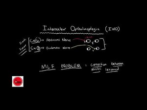 Internuclear ophthalmoplegia (INO) BASIC & QUICK EXPLANATION