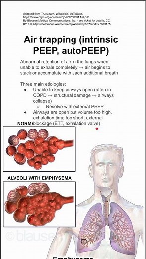 Air trapping (intrinsic PEEP, autoPEEP)