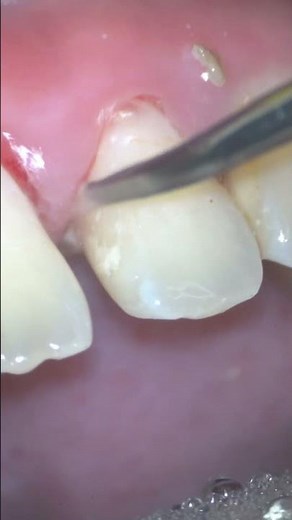Removal of dental calculus