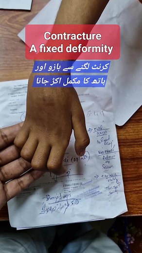 5K views · 73 reactions | Hand deformity - Contracture formation | Dr. Arshad Mehmood - Child Specialist | Facebook