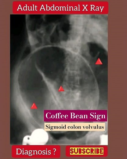 Coffee Bean Sign # Sigmoid colon volvulus # Abdominal X Ray # Radiology