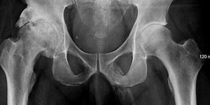 This Man’s Penis Is Literally Turning Into Bone, a New Case Report Finds