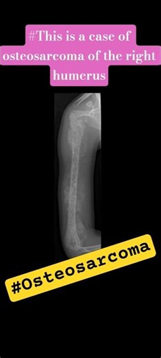 #Case of osteosarcoma,Bone Cancer of the right humerus #shorts