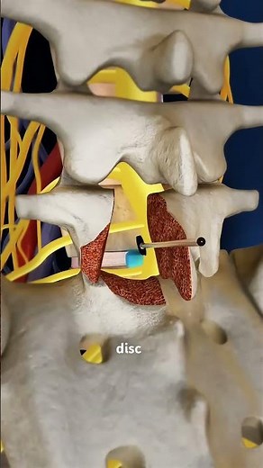 Lumbar Fusion Surgery Explained 🦴 | Spinal Stability & Pain Relief - 3D Animation#LumbarFusion