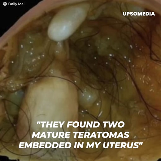 4K views · 28 reactions | A girl named Page thought she was pregnant, as she had all the symptoms, however, when she arrived at the hospital she would be in for a huge surprise when she found out that what she really had inside was a hairball and not only that… they would have to remove it as soon as possible. Acknowledgements: Page https://www.tiktok.com/@sandwitchbread?lang=en | The Witness | Facebook