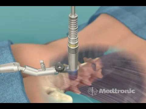 Medtronic METrx system