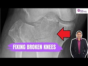 Tibial Plateau Fracture Fixation Techniques Explained | ORIF, MIPPO, Dual Plating & More
