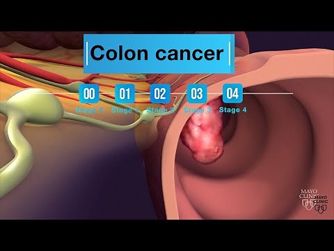 Treatment options for advanced colorectal cancer