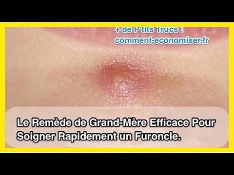 Le Remède de Grand-Mère Efficace Pour Soigner Rapidement un Furoncle.