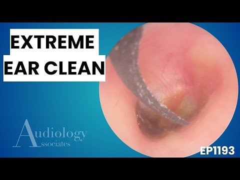 Extreme Ear Wax Removal | Solid Keratin Plug Deep Clean - EP1193