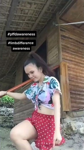 #pffd #pffdawareness #limbdifference #limbdifferenceawareness #differentlyabled