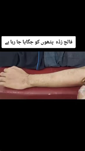 1.3K views | Stroke Patient Muscles Stimulation.#PediatricTherapy #ToeWalking #FunctionalTherapy #PediatricPT #StrongSteps #stroke #physicaltherapy | Choose Physiotherapy First | Facebook