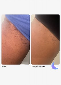 Topicals | Anti Ingrown Hair Serum - High Roller | Topicals