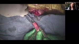 AUA25 Insights: Malleable Penile Prosthesis Insertion in Cloacal Exstrophy