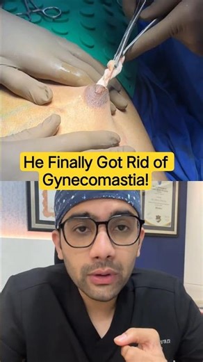 Gynecomastia Result On Suture Removal Day | Dr DC, Plastic Surgeon Pune, India #gynecomastiasurgery