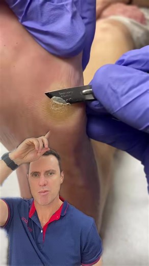 Foot Callus Removal Explained by a Podiatrist