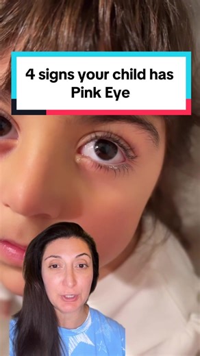 This is my daughter with pink eye. She picked it up from school. We used Eye Boogies spray 3x a day on closed eyes and within 48 hours all symptoms cleared! So easy to use. Spray on closed eyes 2-3x a day. No wipe necessary, non- toxic, and you don’t have to wipe it off. Helps kill the bacteria and virus that causes pink eye. #pinkeye #viralconjunctivitis #bacterialconjunctivitis
