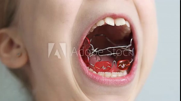 orthodontic appliances for correcting malocclusion in a childs mouth. Removable orthodontic appliances. Wide open mouth with a bite plate installed. Functional devices for aligning bites large