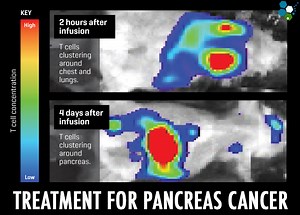 CAR T-cell Immunotherapy & Stem Cells for Pancreas Cancer