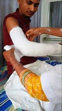 Long arm full plaster #casting #hospital #orthoconcepts #ourtreatment #medicaltreatment #fracture
