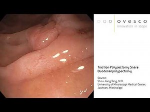 Traction Polypectomy Snare | Duodenal polypectomy
