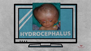Hydrocephalus (Fluid in your Brain)