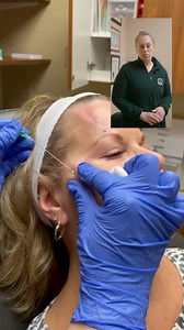 Need a lift? PDO Threads are a great surgical alternative for those...