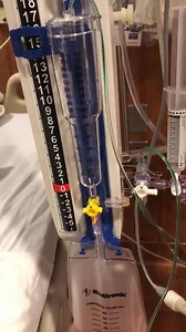 Not much going on today so why not show how her external shunt is doing. The drain is placed in her left ventricle and it empties into this iv bag beside her bed. Her CSF (cerebral spinal fluid) output per day averages 500 ml. Healthy ventricles produce CSF and move it around the brain. Beth’s ventricles produce CSF but they don’t properly move it around the brain. This causes a build up of CSF and that’s how Beth was diagnosed with hydrocephalus around 5 months old. It’s extremely common for ki
