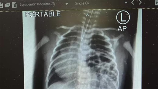 Successful thoracoscopy for CDH in a 37-week neonate at SQUH | Dr. Zainab Al Balushi posted on the topic | LinkedIn