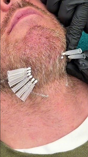 V Soft Line Threads: Dr. Javed Performs Non-Surgical Lift at Neo-Derm